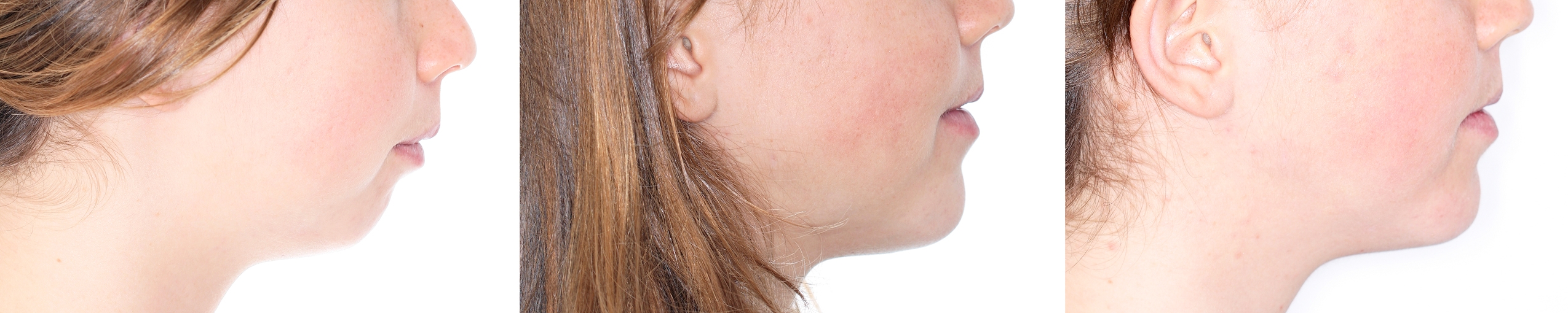 Terceiro Molar - Dente do Siso