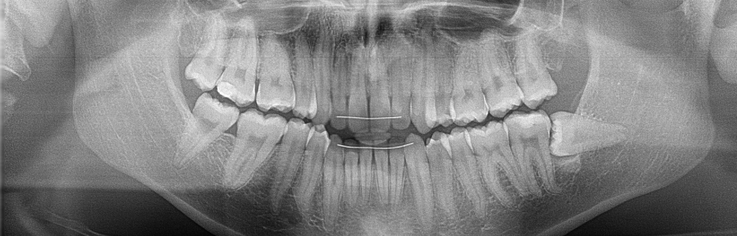 Terceiro Molar - Dente do Siso