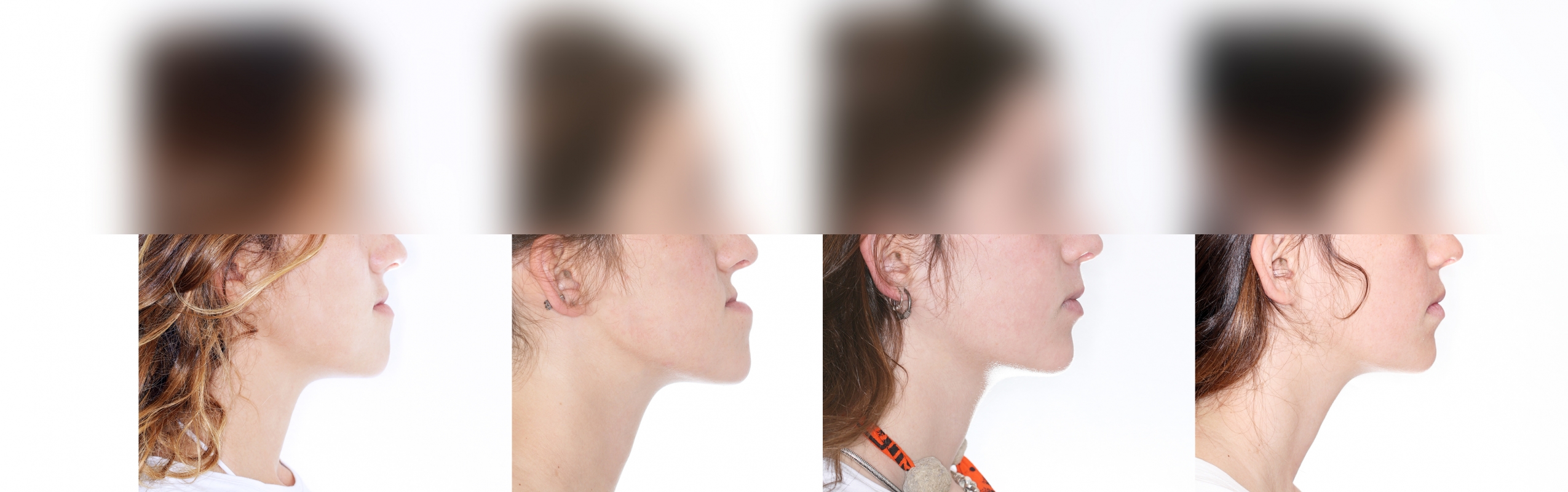 Terceiro Molar - Dente do Siso